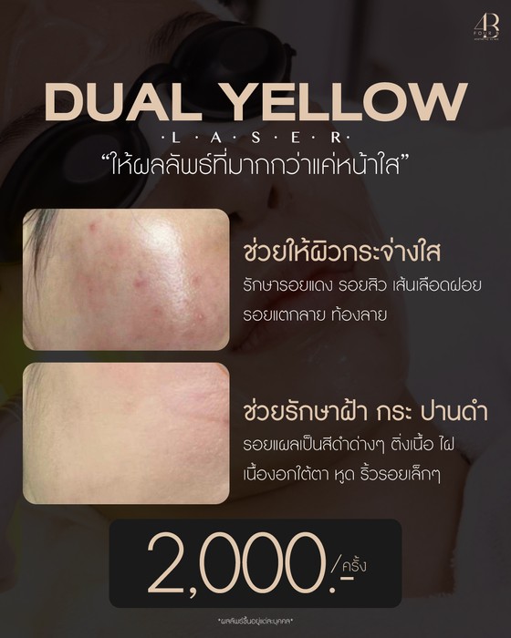 Dual Yellow Brightening Laser