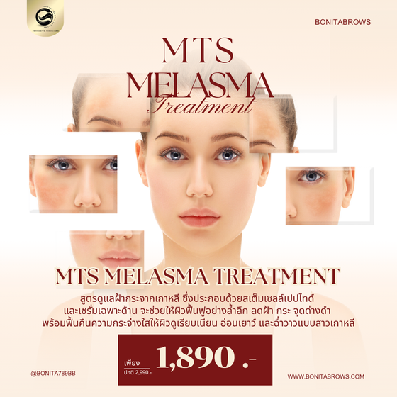 MTS Melasma Treatment