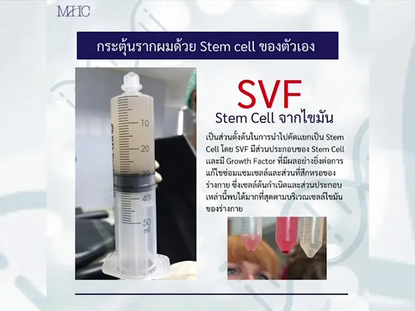 SVF (Stromal Vascular Fraction)