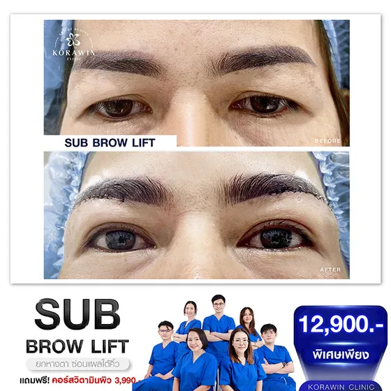 โปรโมชั่น Sub brow lift